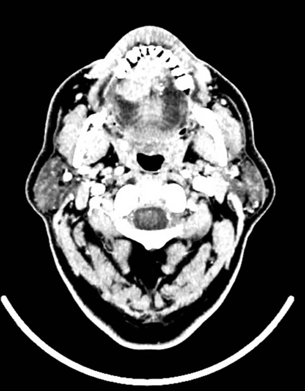 RBCP - Microsurgical Cathedral-Shaped Free Flap Reconstruction ...