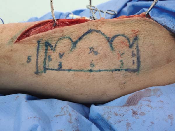 RBCP - Microsurgical Cathedral-Shaped Free Flap Reconstruction ...