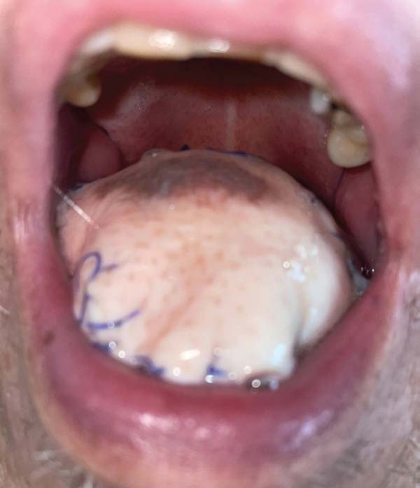 RBCP - Microsurgical Cathedral-Shaped Free Flap Reconstruction ...